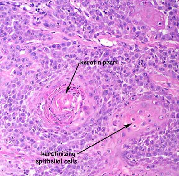 Neoplasia2