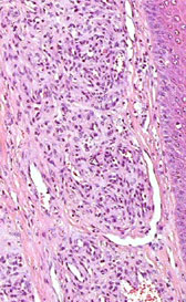 Neoplasia2