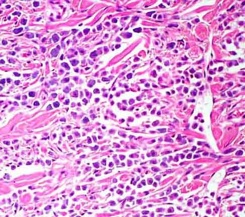Neoplasia2