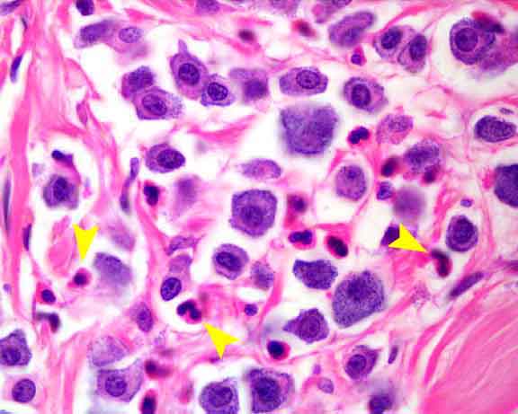 Neoplasia2