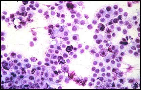 Neoplasia2